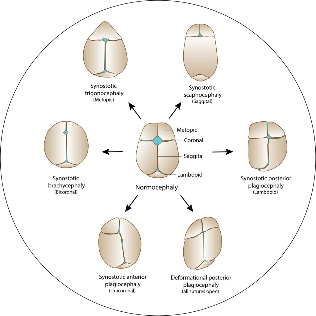 Craniossinostose: O Que é, Causas, Diagnóstico e Tratamento – Dr. Paulo